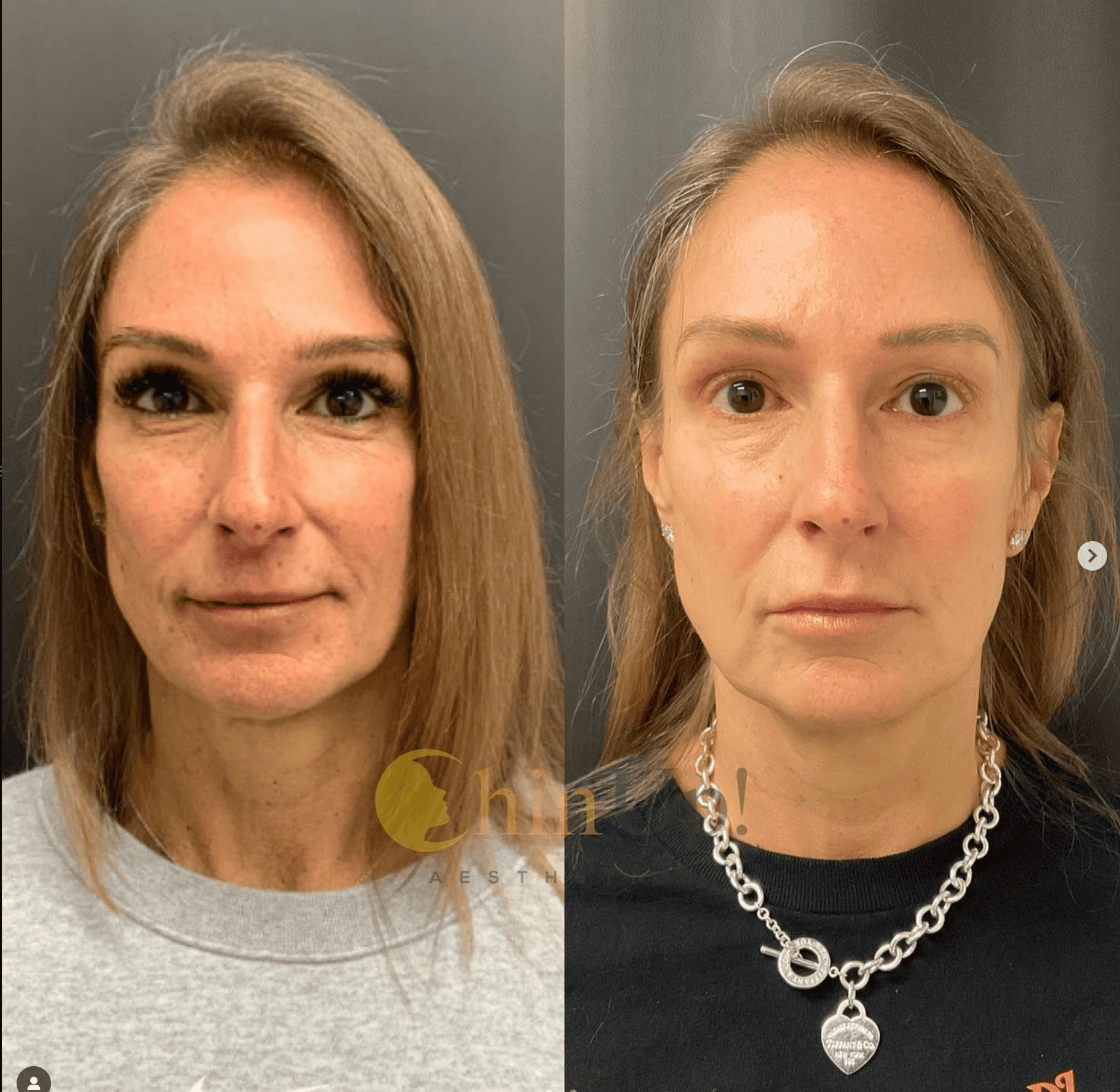 Facial Fillers Before and After: Transformations, Benefits, and What to ...